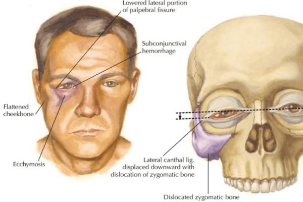Facial Bone Fracture Treatment in Hyderabad - Akruti