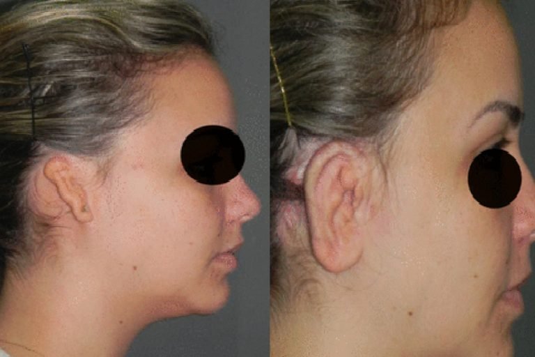 Otoplasty Surgery in Hyderabad - Akruti