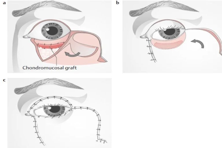 Eyelid Reconstruction Surgery in Hyderabad - Akruti