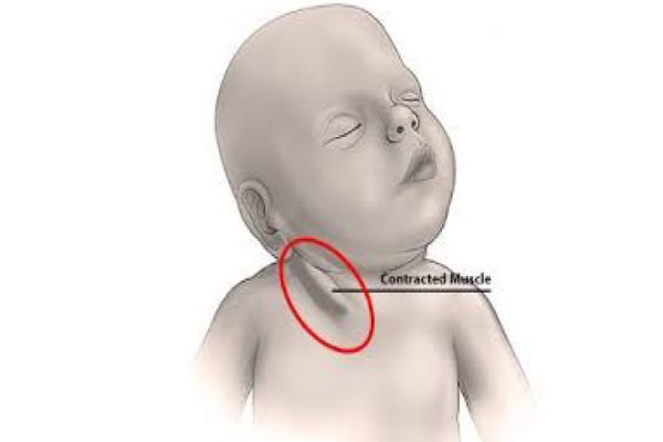Torticollis Treatment in Hyderabad - Wry Neck Treatment